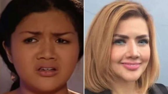 5 Artis Ini Rela Rogoh Kocek Uang Miliaran demi Operasi Plastik Wajahnya, Foto Before-Afternya ...